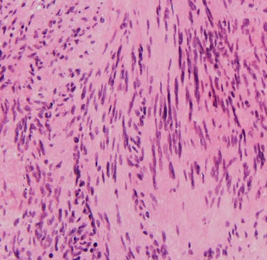神経鞘腫の病理 pathology of schwannoma | 脳外科医 澤村豊のホームページ