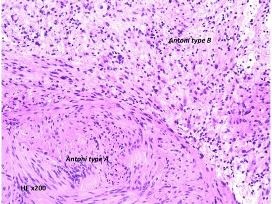 神経鞘腫の病理 pathology of schwannoma | 脳外科医 澤村豊のホームページ
