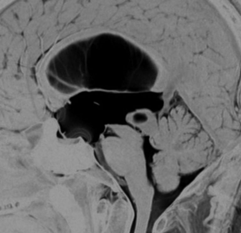 中脳視蓋グリオーマ tectal glioma, tectal plate glioma | 脳外科医 澤村豊のホームページ
